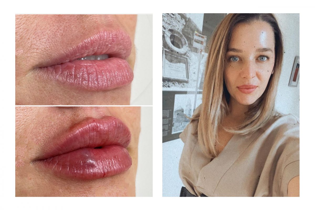 Doktorka Zlata: Kako da povećaš usne, a da ne ličiš na karikaturu