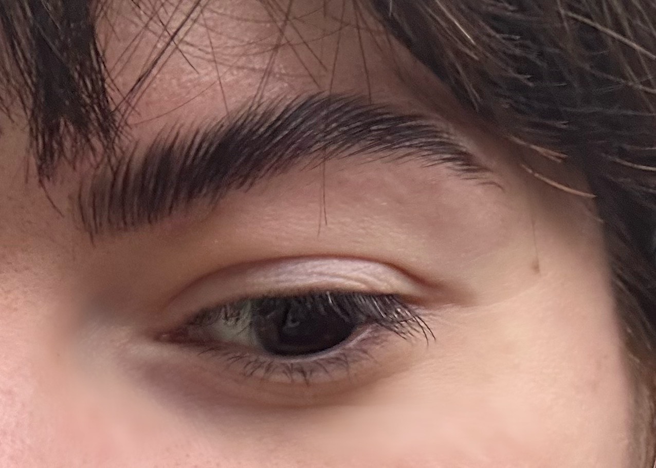 Radila sam "brow lift" i imam savet za sve devojke koje žele ovakvu promenu